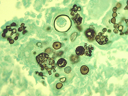 Valley Fever, Explained – Mother Jones